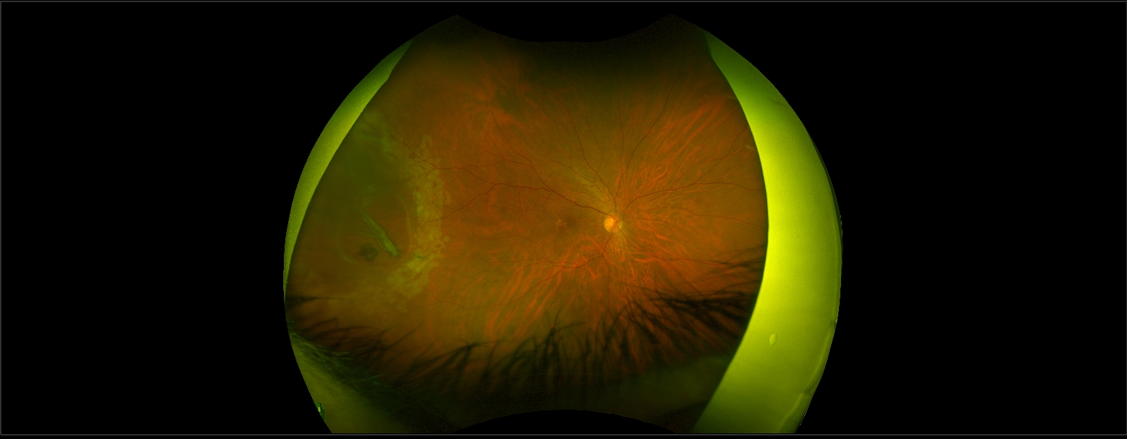 Flashes & Floaters – Retinal Tear Treatment - Retina and vision institute