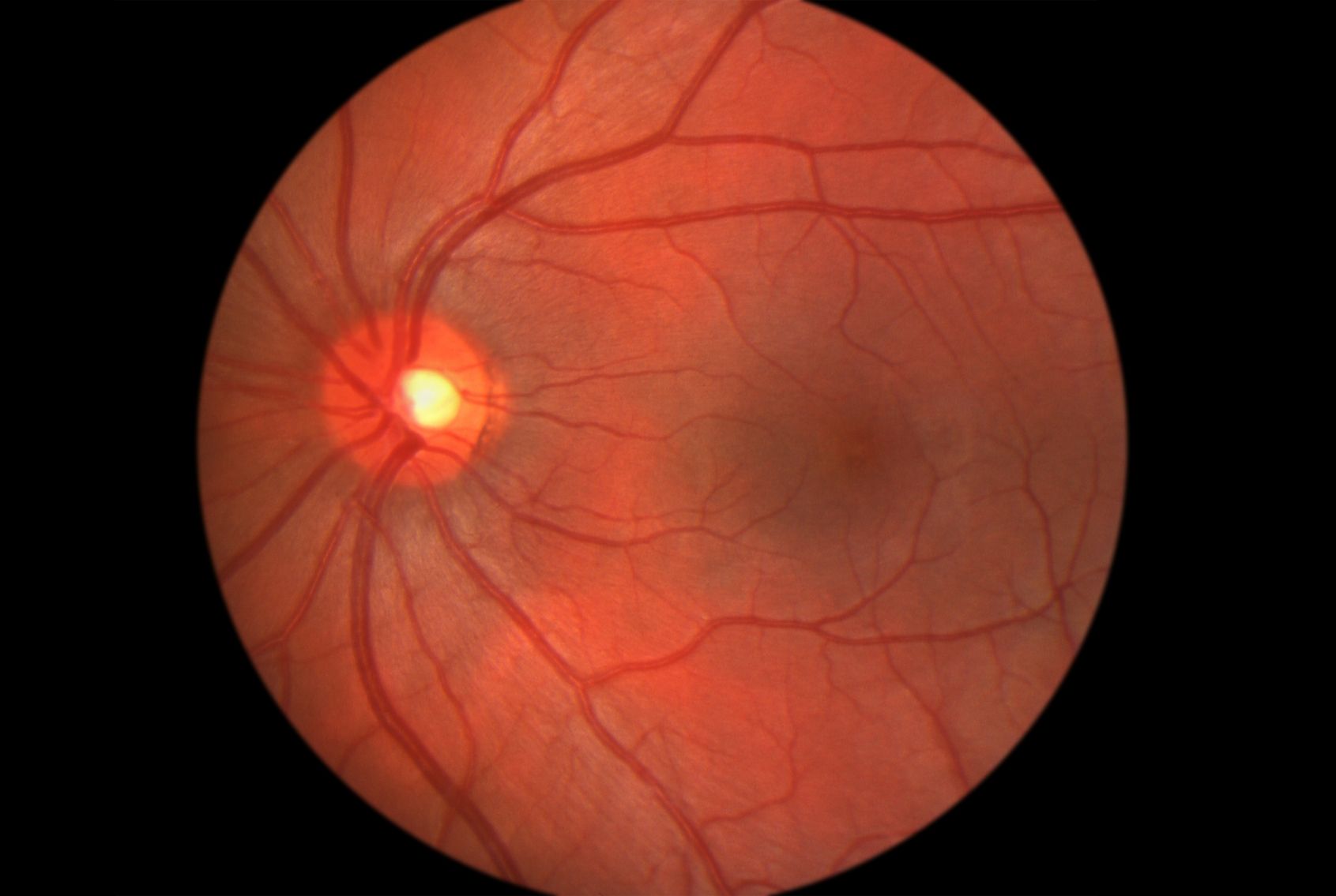 Posterior Vitreous Detachment - Retina and vision institute
